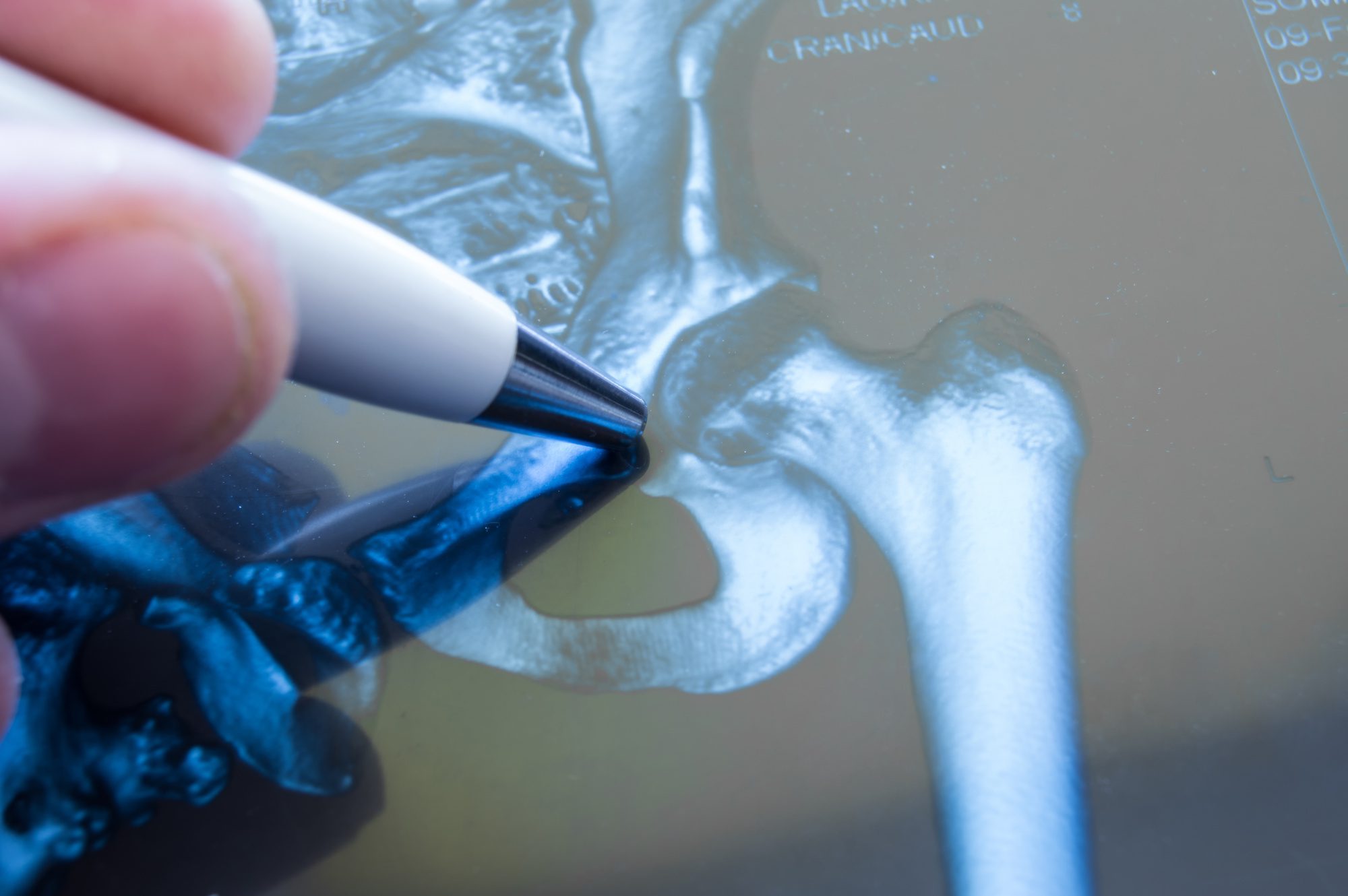Hip Replacements – What to Expect and How to Prepare - Dr. Paul ...
